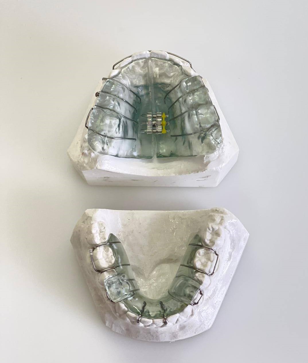 Orthodontics for Children – Ipswich Ortho